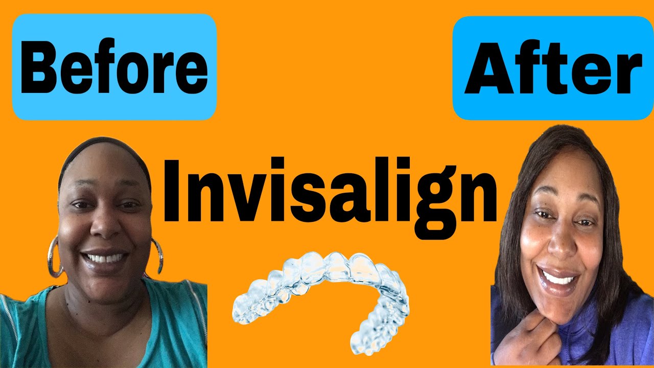 I finally got my Invisalign removed ~ Invisalign journey update - YouTube