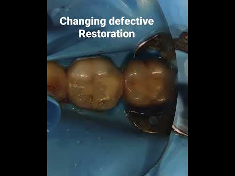 Re(Restoration) Class 1 and class 2 composite resin restoration case ...