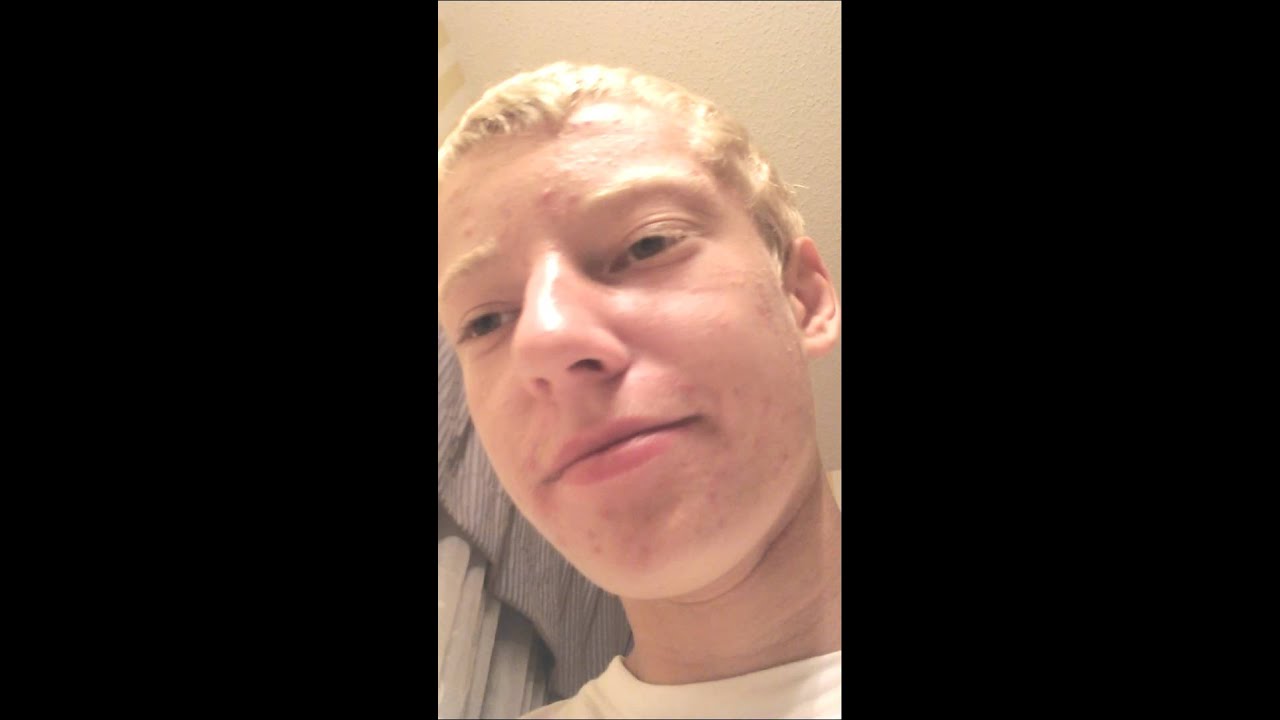 Solodyn/ tazorac/ minocycline week 1 - YouTube