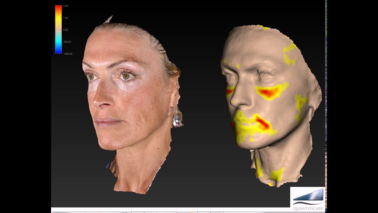 Before-After volume quantification by Quantificare - YouTube