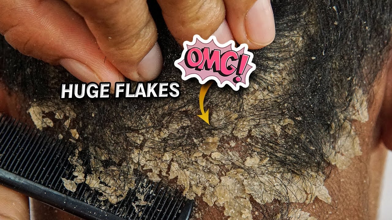 Psoriasis Scalp Removal - Dandruff Scratching - YouTube