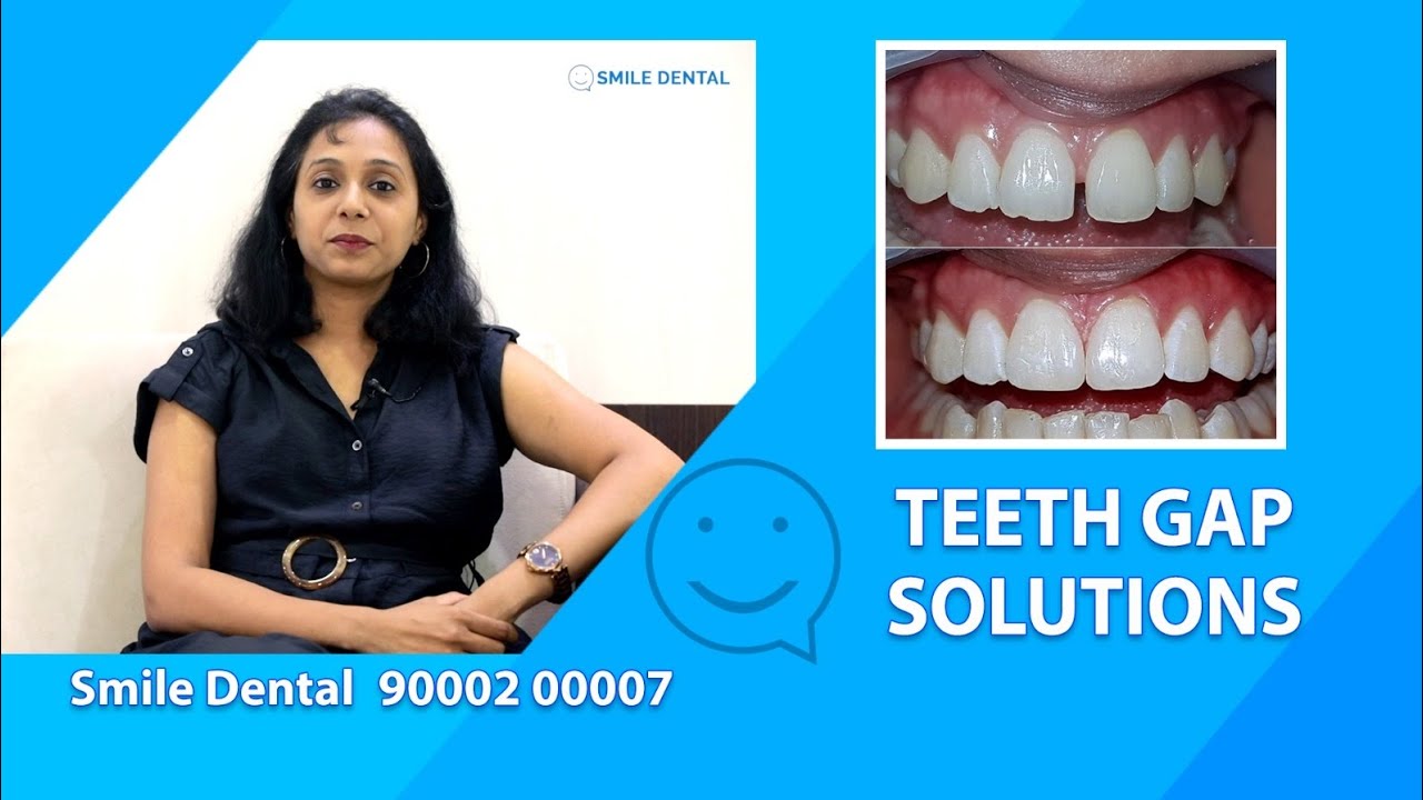 Teeth Gap Solutions @smiledentalindia - YouTube