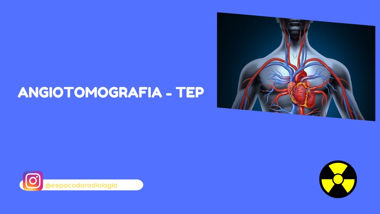 [ANGIOTOMOGRAFIA]: Angiotomografia para diagnóstico de TEP - Trombo embolia pulmonar. - YouTube