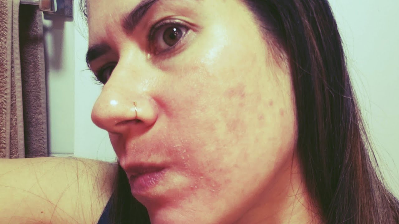 Vitacid Acne e pele queimada - YouTube