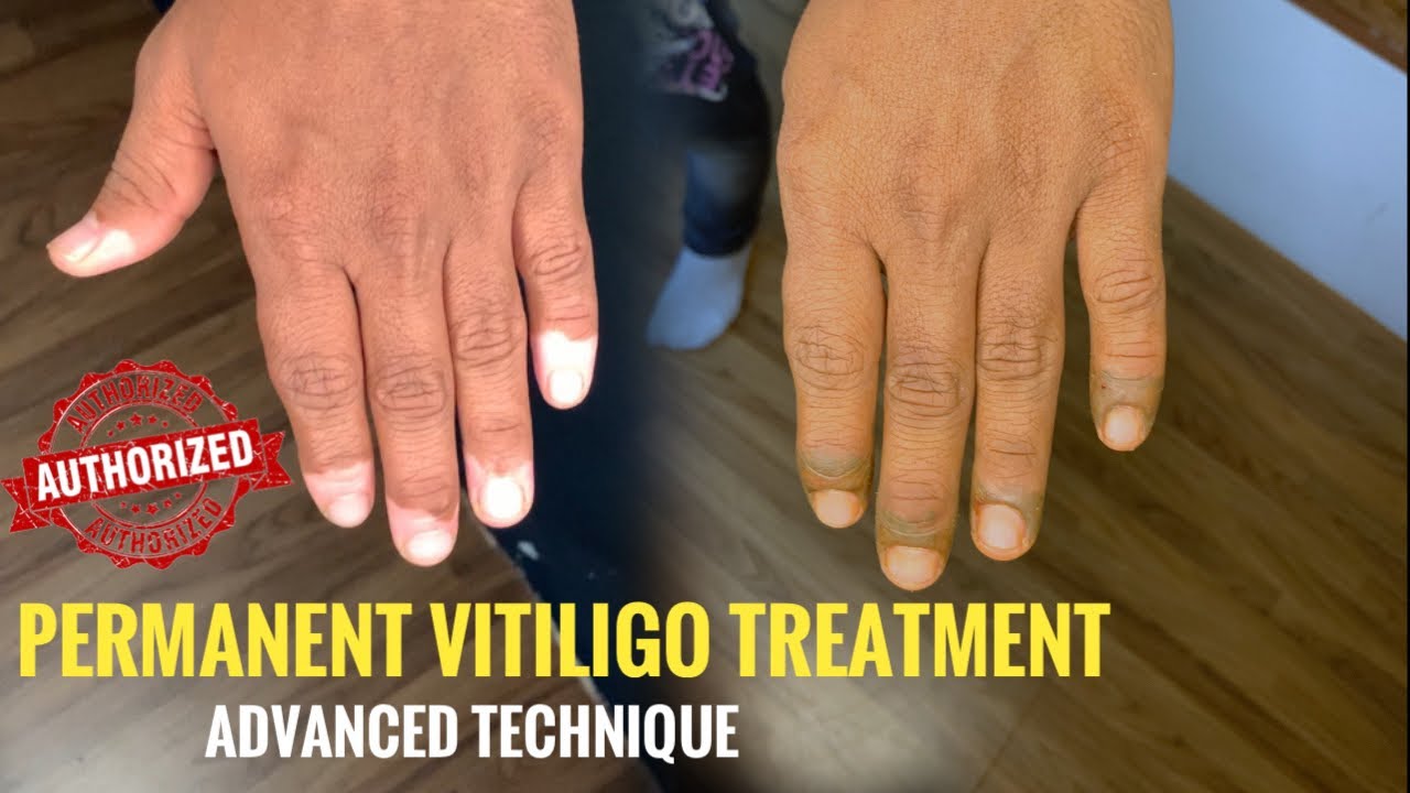 Vitiligo Hand Tattoos