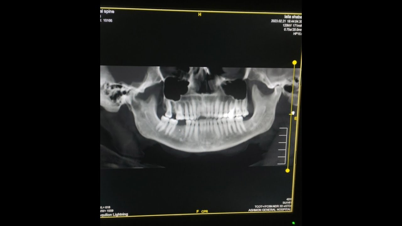 Mandible curve with ct - YouTube