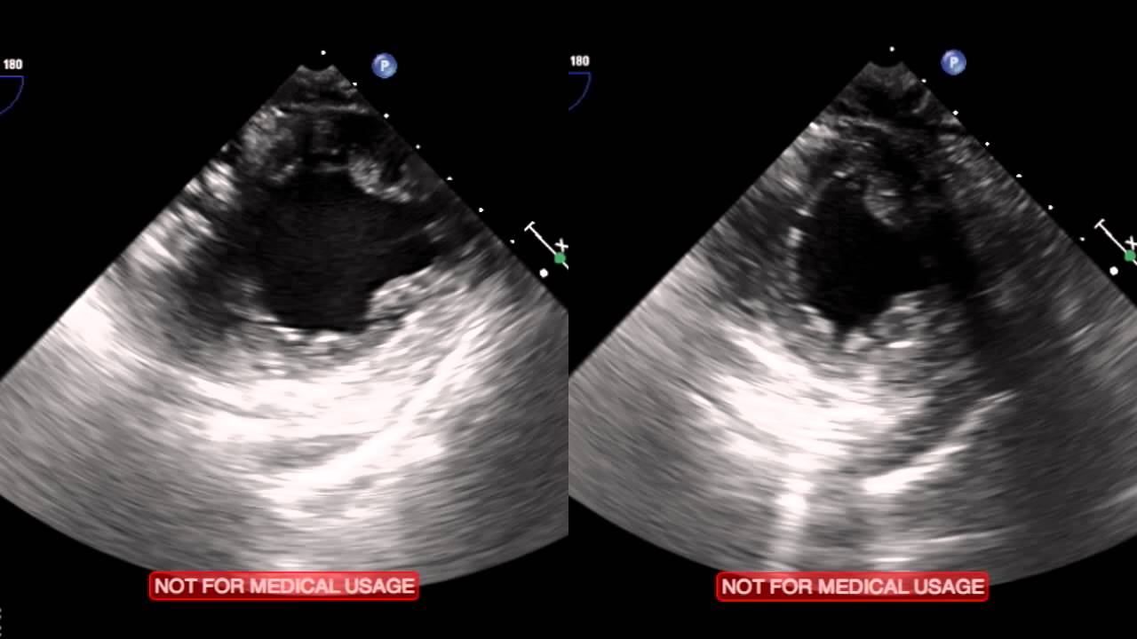 TEE for CABG surgery - YouTube