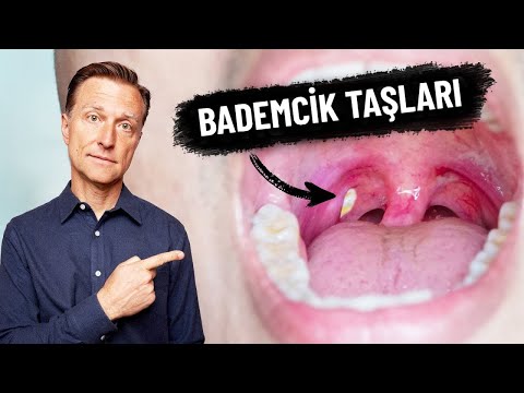 Bademcik Taşlarına Ne Sebep Olur ve Nasıl Önlenir? | Dr.Berg Türkçe
