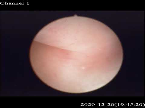 Hysteroscopic Polypectomy Dr Ibrahim Saif Elnasr - YouTube