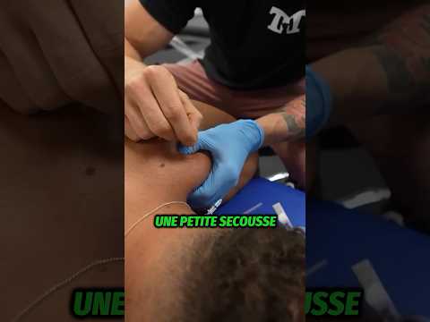 Une aiguille dans le muscle pour diminuer la douleur ?! 😱