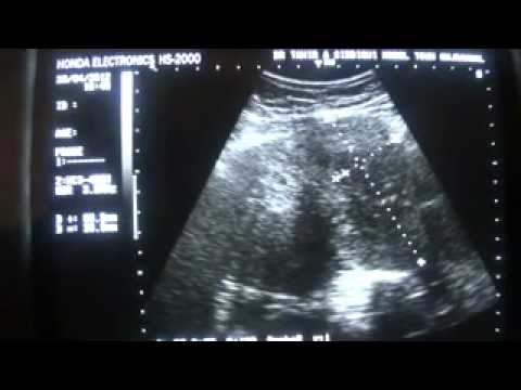 FIBROIDS; INTRAUTERINE AND PEDUNCULATED EXTENDING and EXPANDING - YouTube