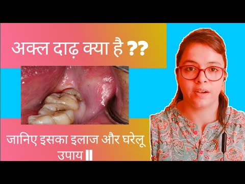 अक्ल दाढ़ क्या है ??|| Wisdom tooth|| इलाज और घरेलू उपाय || - YouTube