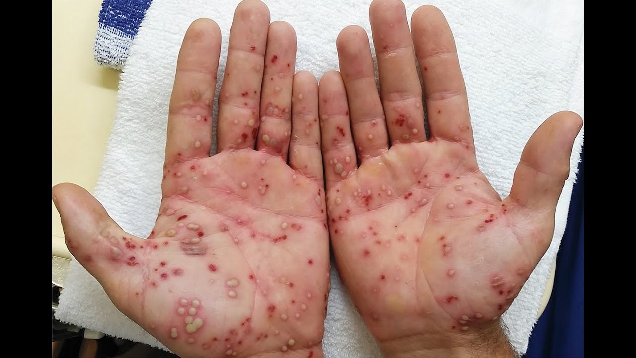 Poststreptokokken Pustulosis palmaris - YouTube