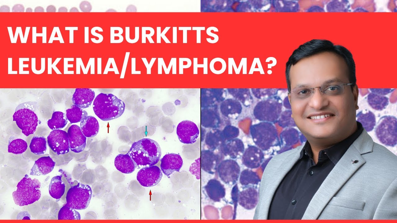 What is Burkitts Leukemia or Lymphoma | Sign & Symptoms, Treatment ...
