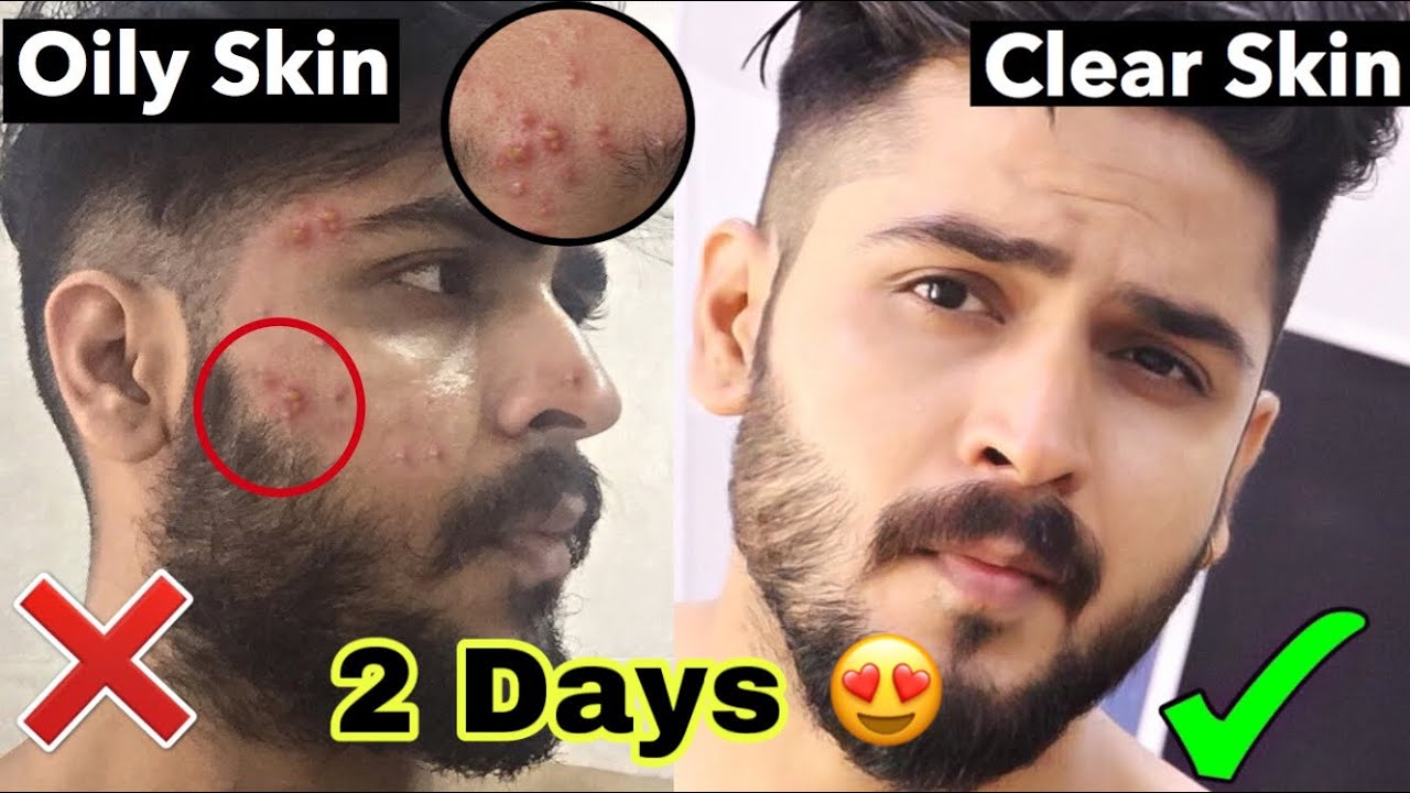 Pimple, Dark Spots Remove Tips | Summer Pimple Mistakes | Remove Pimple ...