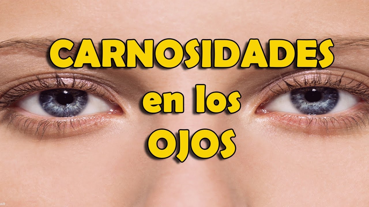 Carnosidades en los ojos | Lo que debes saber - YouTube