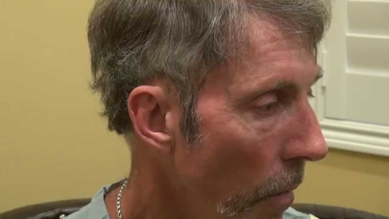 Sideburns Hair Loss Transplant Surgery Result 1 Year After Facial Hair ...