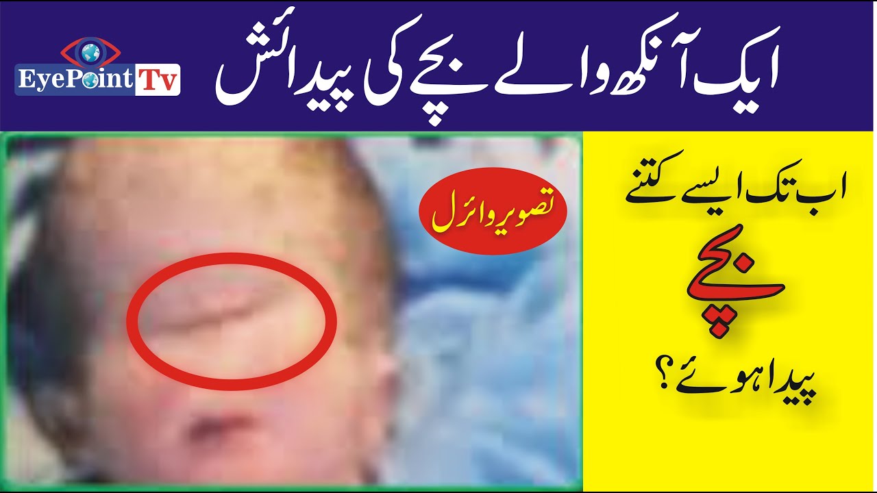 Birth of a one-eyed child | ایک آنکھ والے بچے کی پیدائش | EyePoint Tv ...