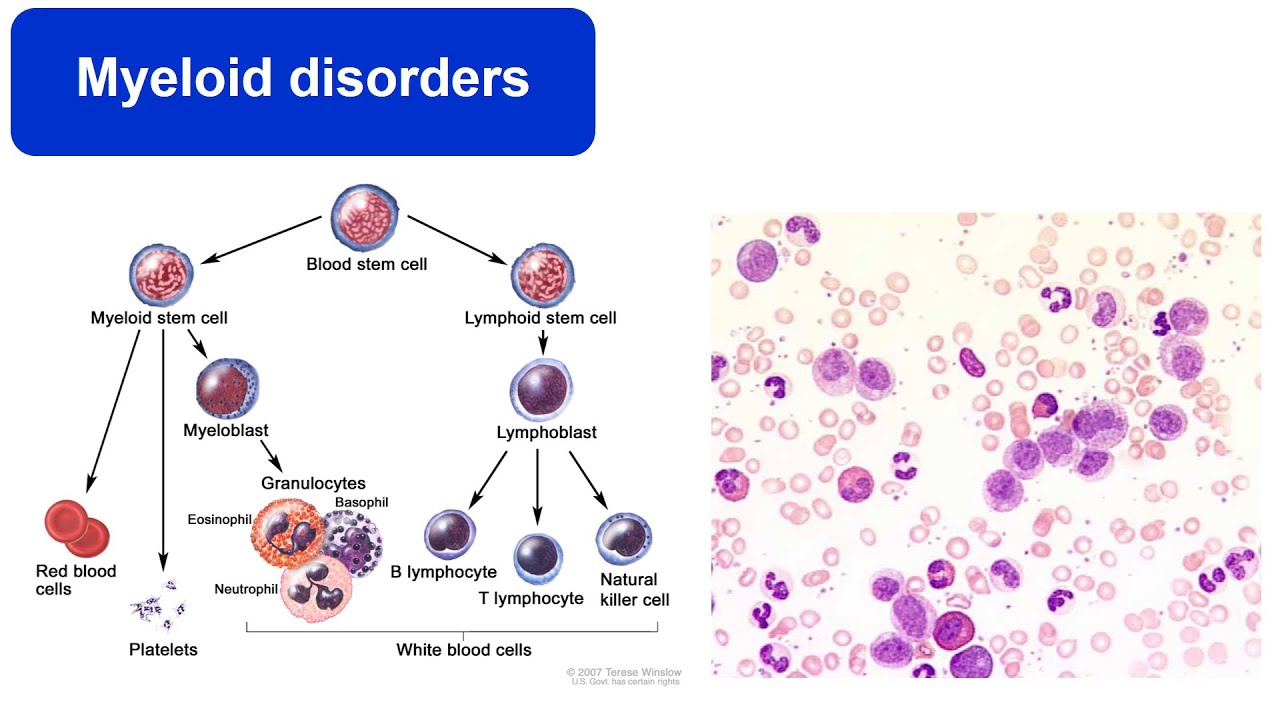 Myeloid diseases - YouTube