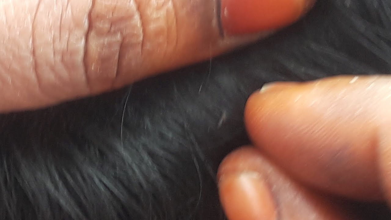 OMG! fully nits in sister black hair Part1/Real sounds Nitpicking in ...