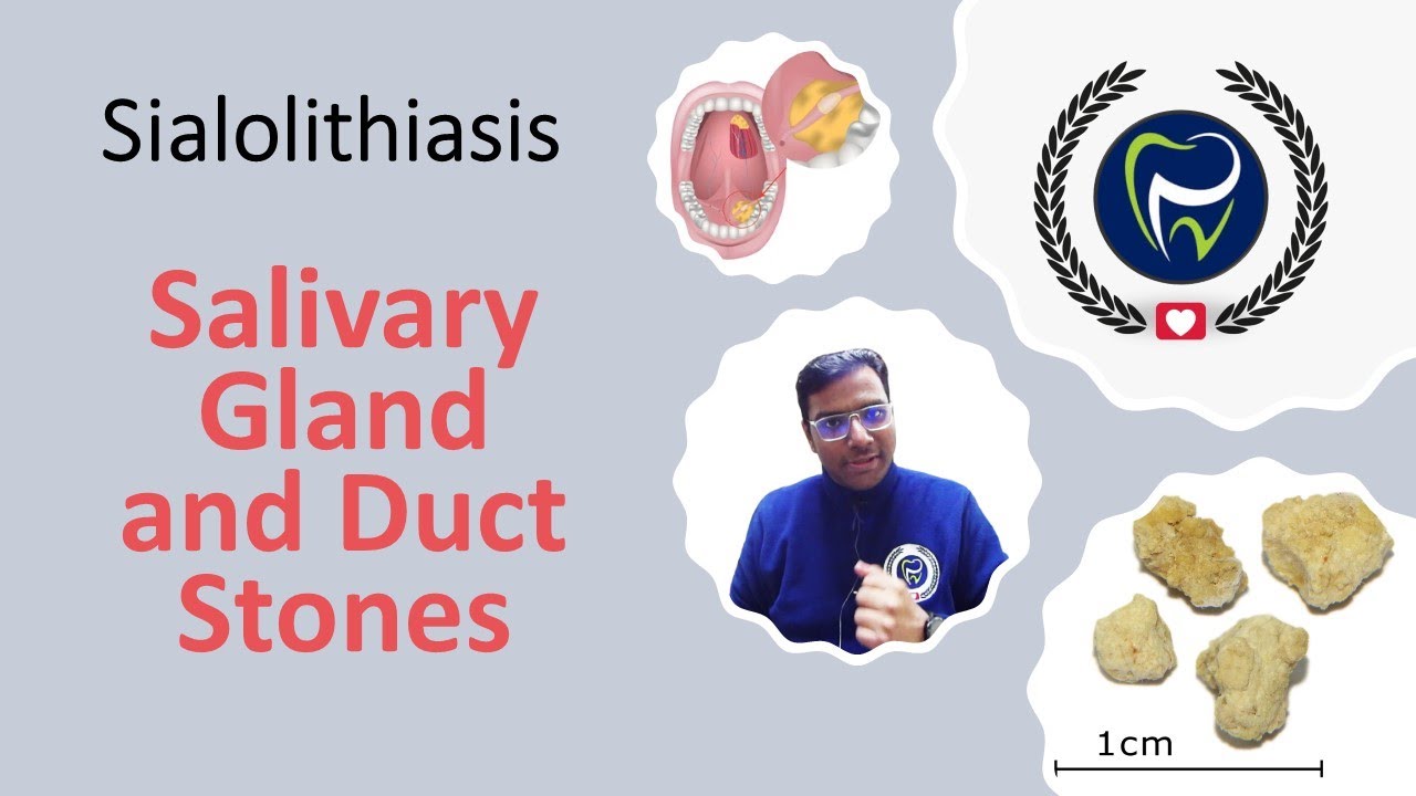 Dr Rudra Mohan | Sialolithiasis |Salivary Gland /Duct Stones |Painful ...