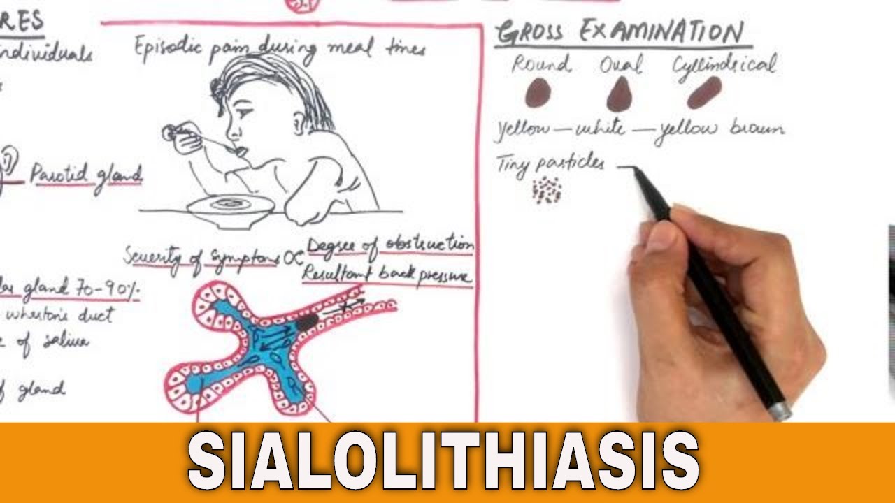 Sialolithiasis / Salivary Stones - Pathogenesis, Clinical features ...