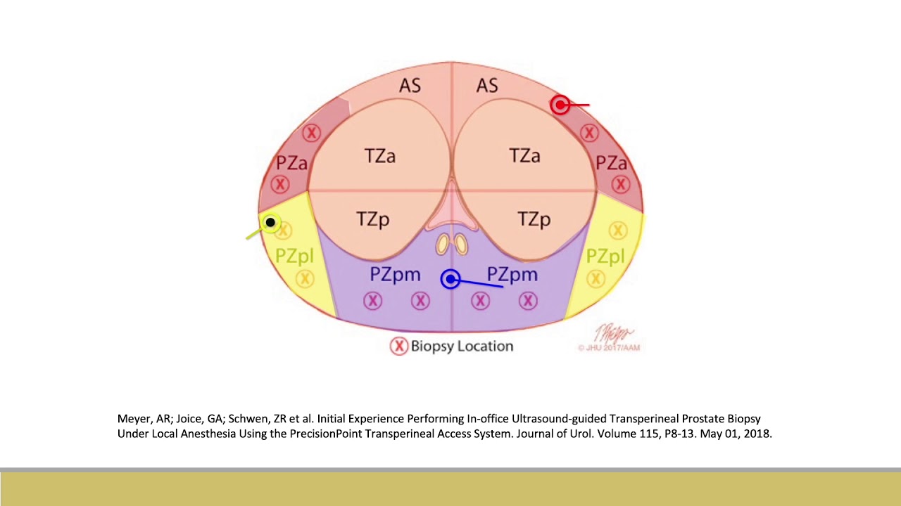 Core Videos (2020): Transperineal Prostate Biopsy Demonstration - YouTube