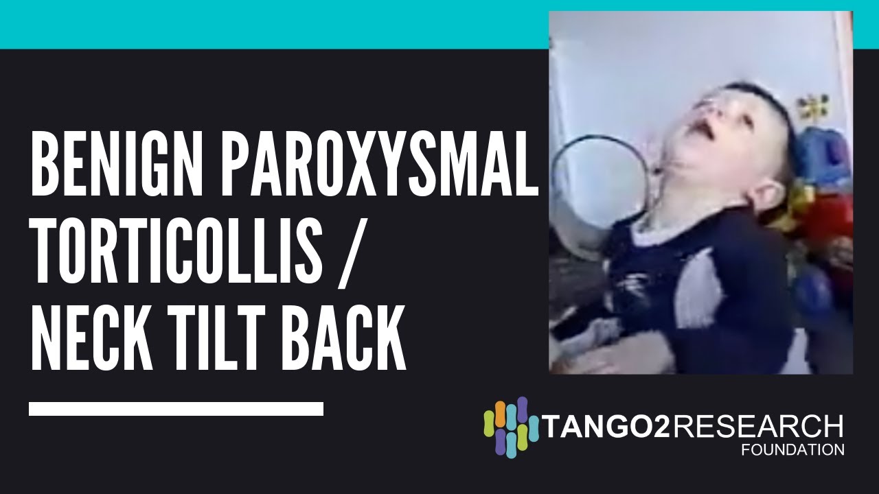 Benign Paroxysmal Torticollis (Neck Tilt Back) / TANGO2 Research ...