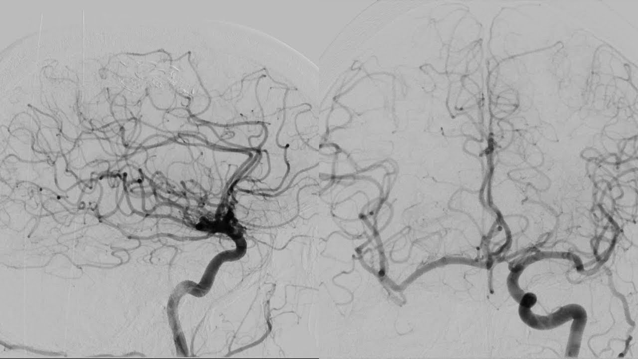 Stroke. Right Carotid Occlusion. Distal aspiration + Stentriever - YouTube