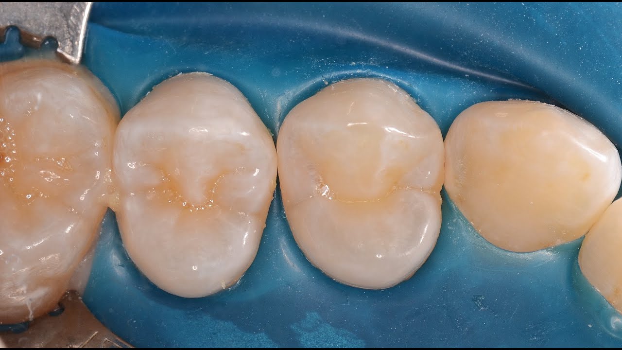 Small proximal caries HD - YouTube