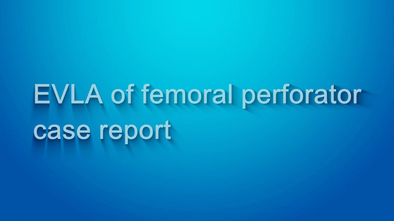 Dodd mid thigh perforator EVLT - YouTube