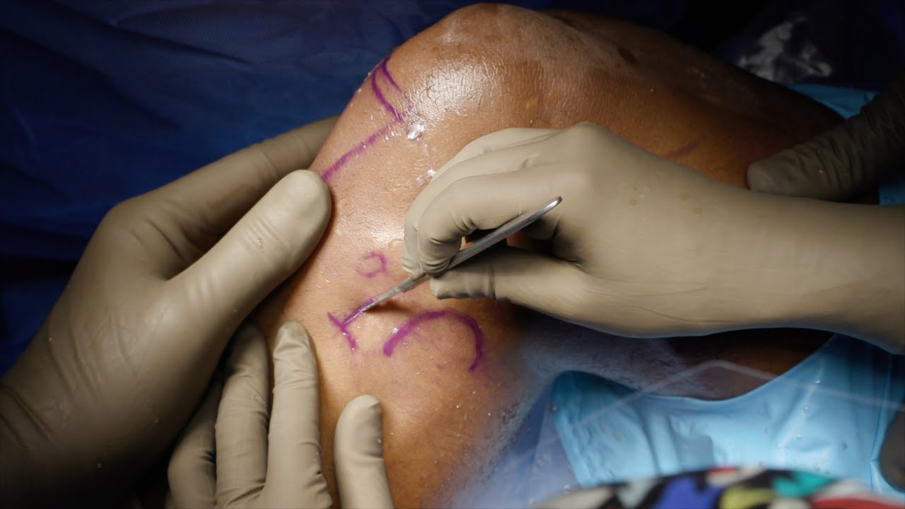 Fibular Head Resection for Biceps Femoris Snapping Syndrome | Dr. Laith ...