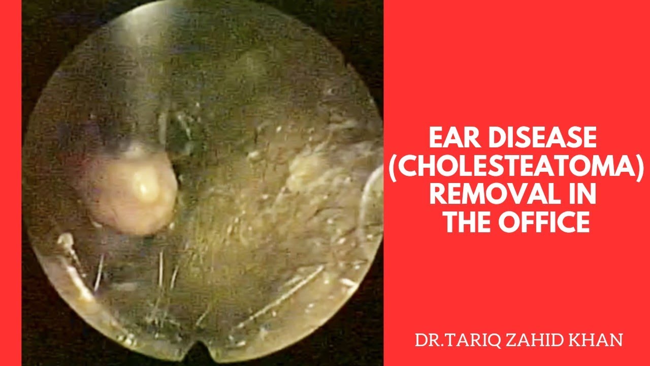 EAR disease(Cholesteatoma) removal in the office. - YouTube