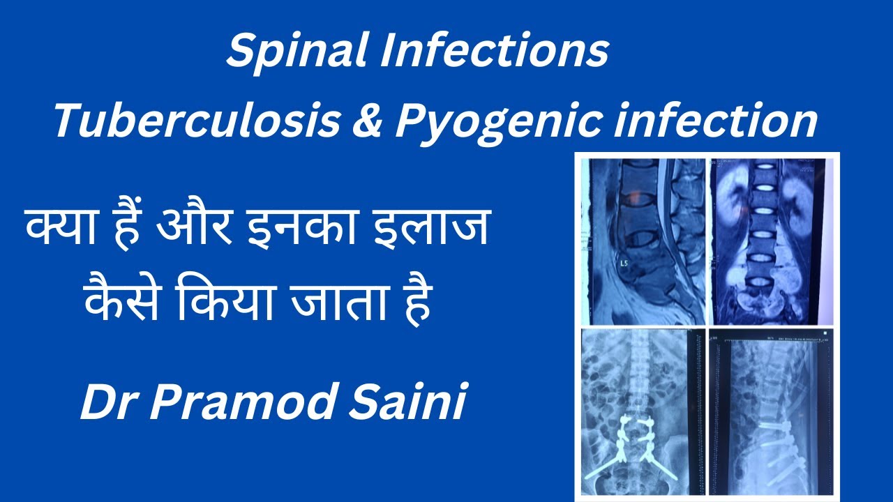 Infections of Spine - Tuberculosis & Pyogenic Infection of Spine | Dr ...