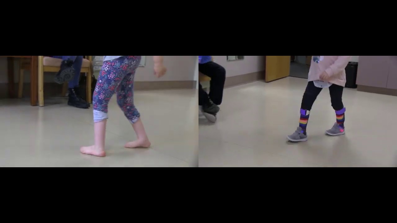 Before & After | Moderate Crouching | DAFO 3.5 | Cascade Dafo - YouTube