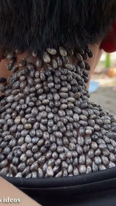 Boy covered in ticks - YouTube