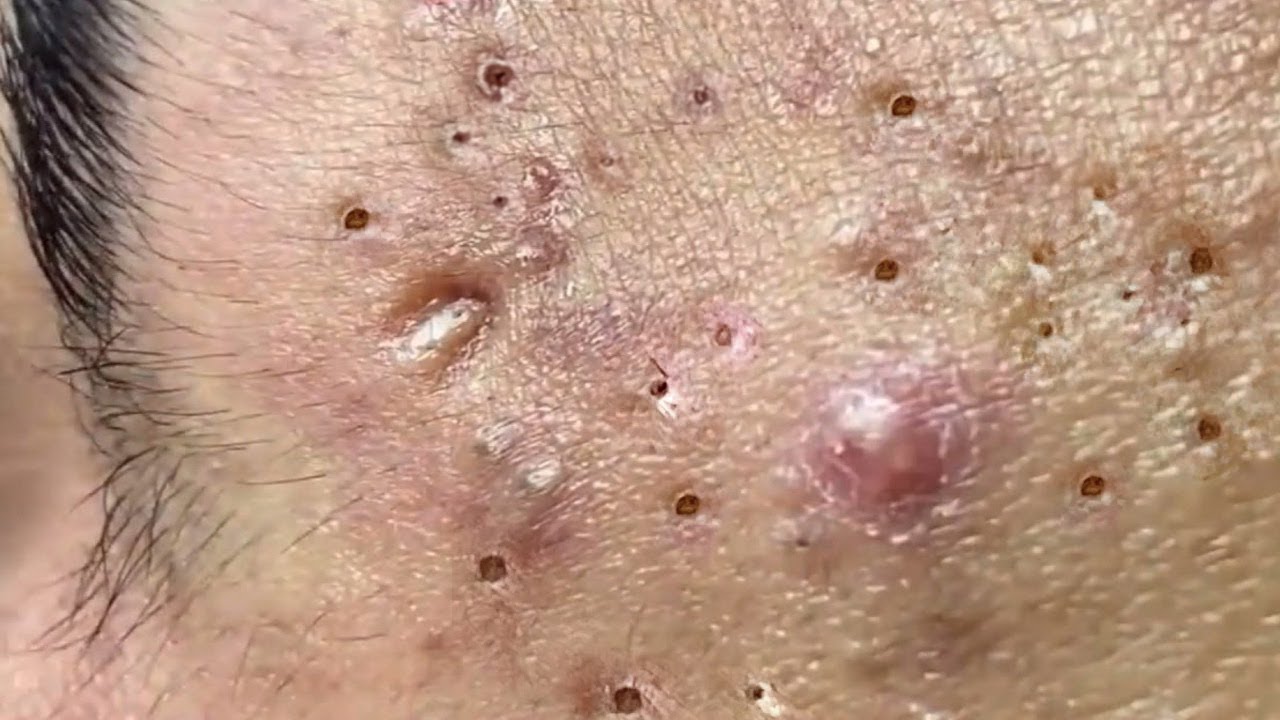 Loan Nguyen Acne Treatment 0885hn - YouTube