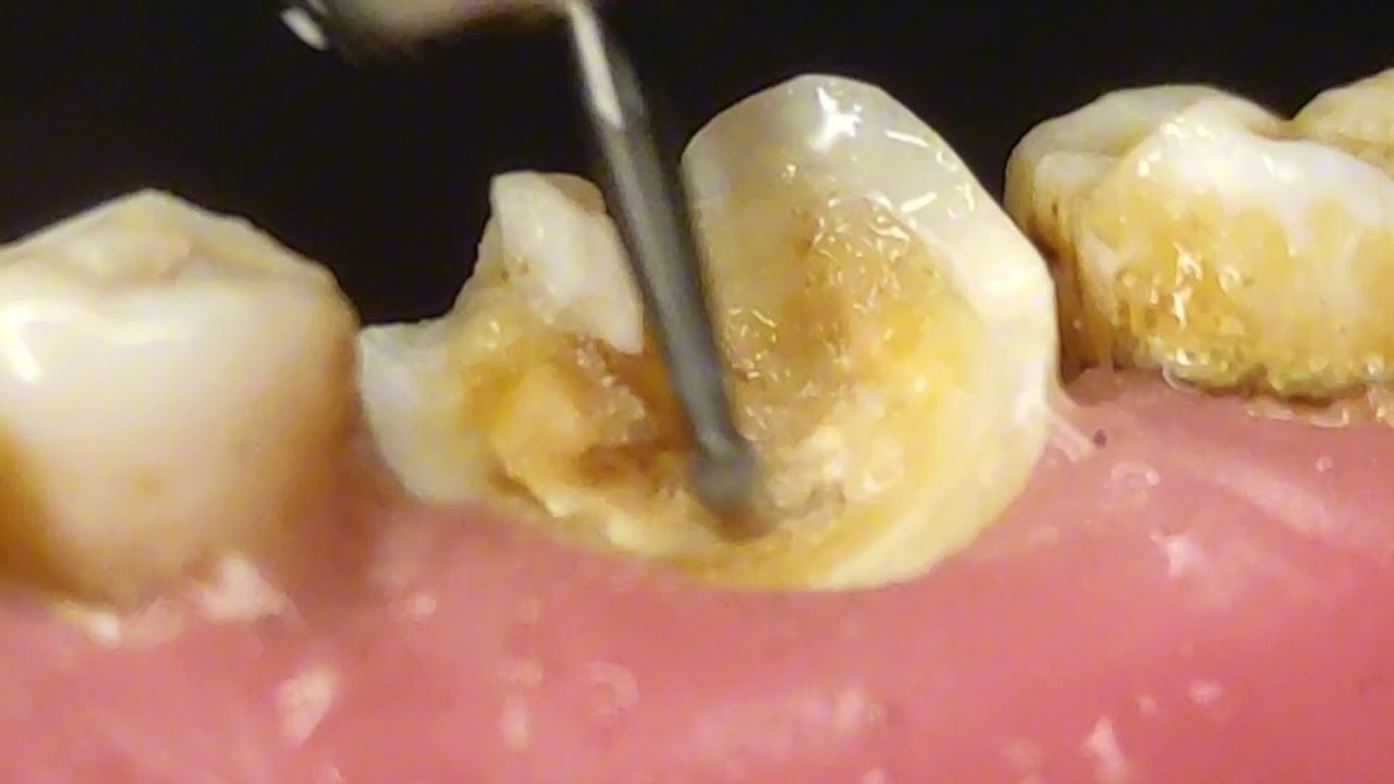 Endodontic treatment, fiber post and build up of badly decayed tooth 🦷 ...