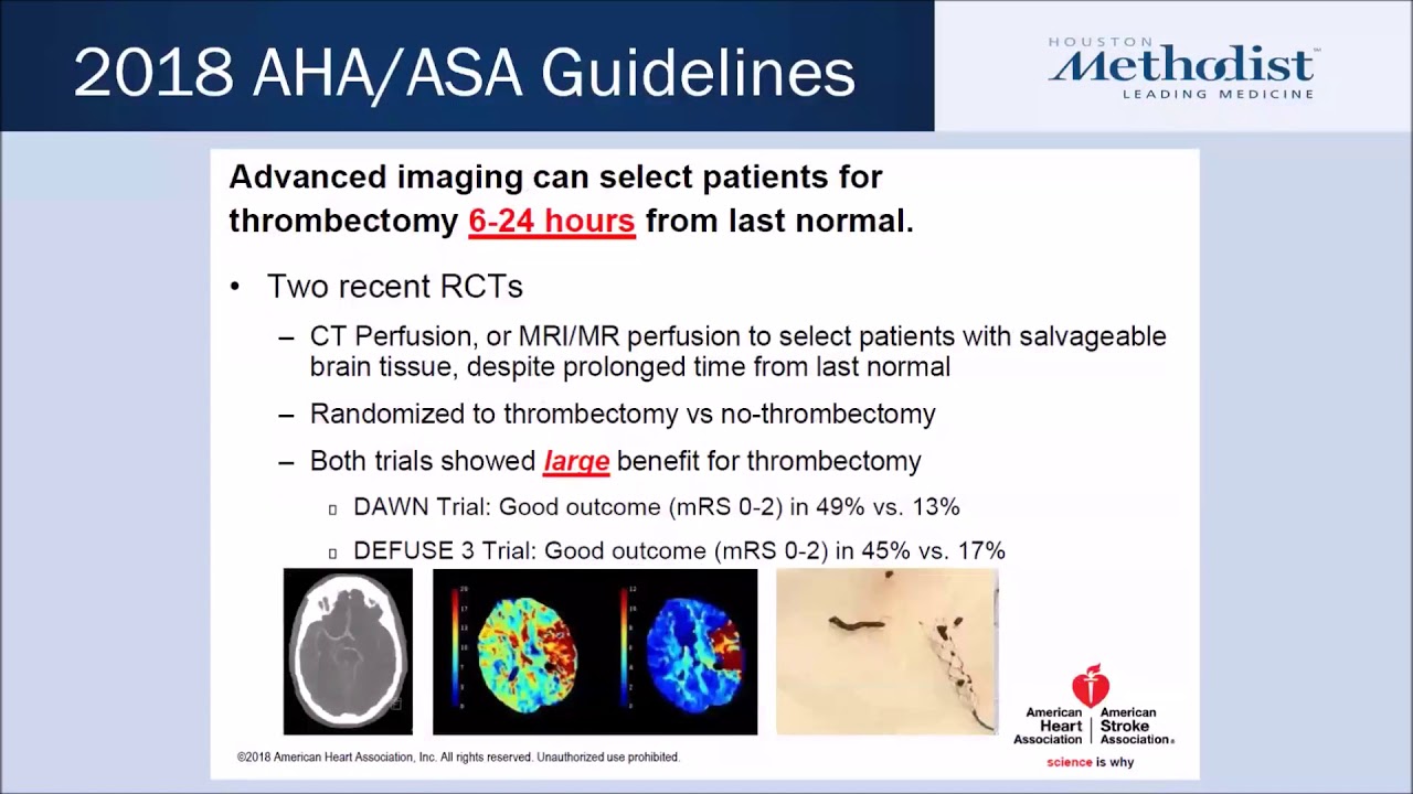 Triage of Acute Stroke using Perfusion Processing for Thrombectomy ...