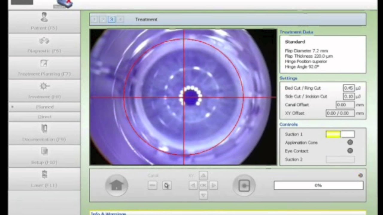Kamra Inlay for Presbyopia: under a LASIK Flap or in a femtosecond ...