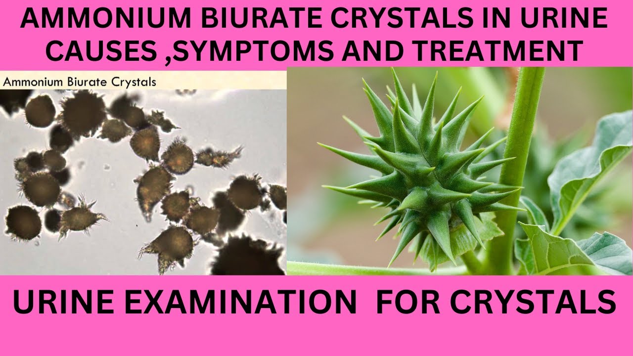 AMMONIUM BIURATE CRYSTALS IN URINE.CAUSES ,SYMPTOMS AND TREATMENT OF ...