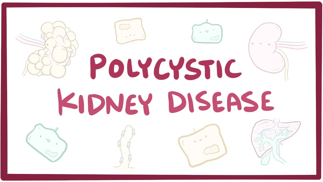 Polycystic kidney disease - causes, symptoms, diagnosis, treatment ...