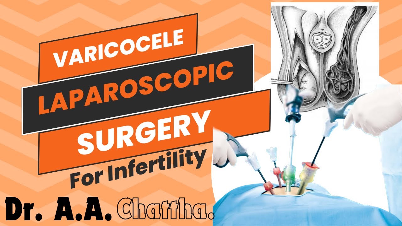 Varicocele Surgery Laparoscopic with Patient Review - YouTube