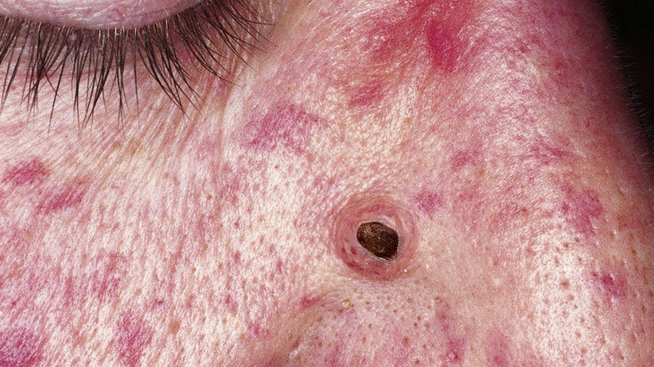 How to Cure Dilated Pores of Winer! Pimple Popping & DPOWs! - YouTube