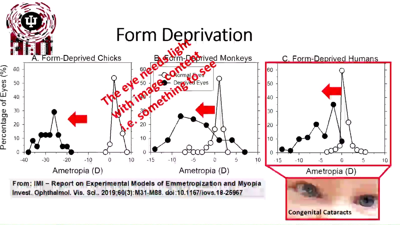 Emmetropization Visually guided growth Source - YouTube