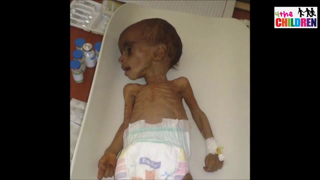 Shocking starving children of Yemen - YouTube