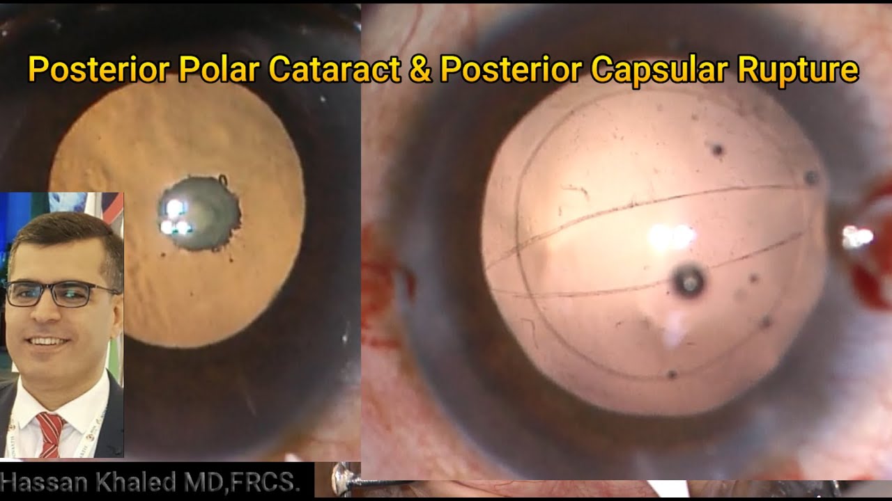 Posterior Polar Cataract & Posterior Capsular Rupture - YouTube