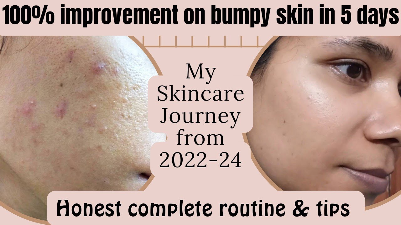 How to treat bumpy skin | Complete honest routine & tips | My skin ...