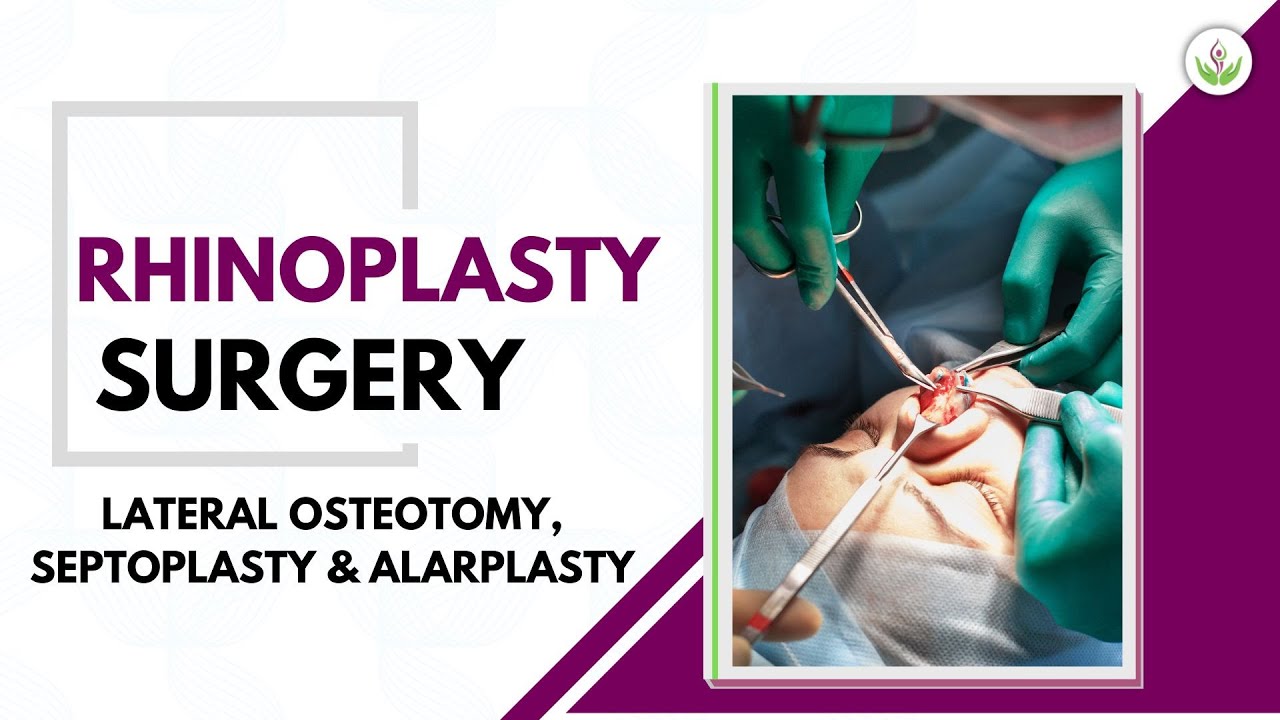 Rhinoplasty Surgery With Lateral Osteotomy, Septoplasty & Alarplasty ...