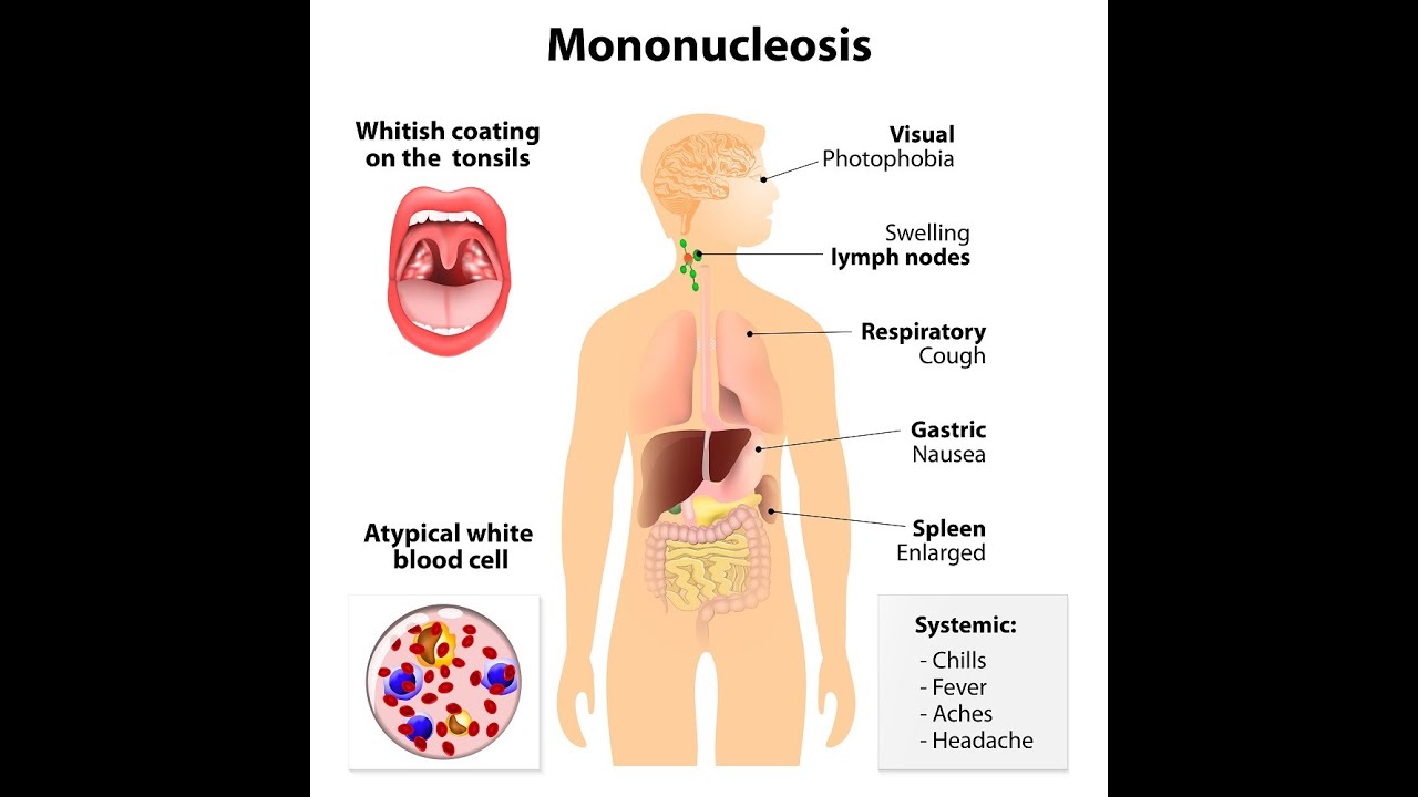 Infectious Mononucleosis Causes Signs And Symptoms Diagnosis And Treatment Youtube